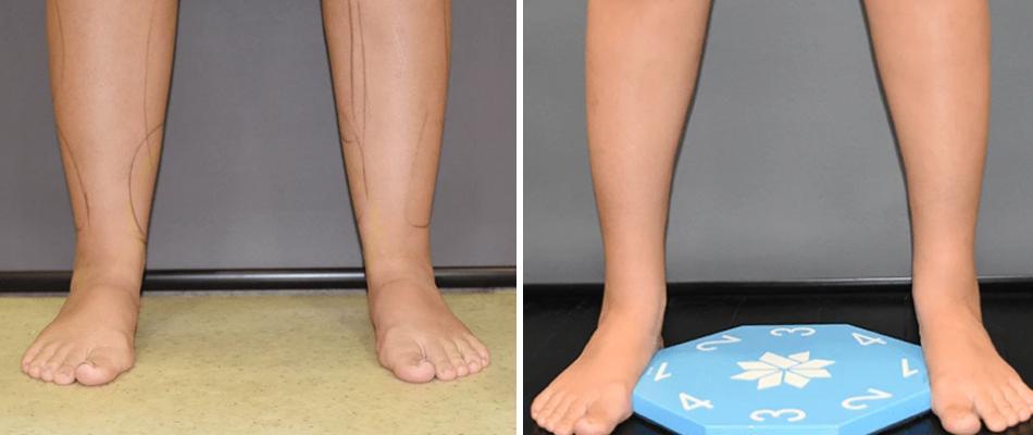 Calf/Ankle Liposuction - Sydney, Gold Coast, Canberra, Adelaide
