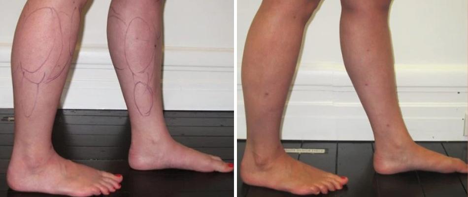 Calf/Ankle Liposuction - Sydney, Gold Coast, Canberra, Adelaide