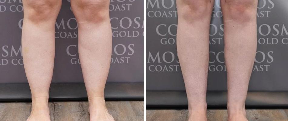 Calf/Ankle Liposuction - Sydney, Gold Coast, Canberra, Adelaide