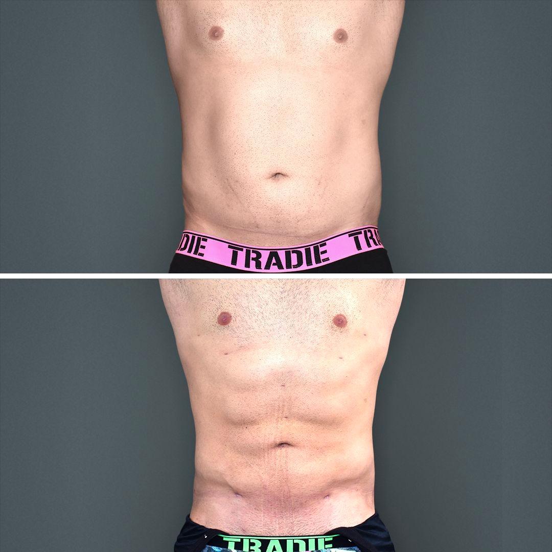 Vaser Liposuction - Sydney, Gold Coast, Canberra, Adelaide