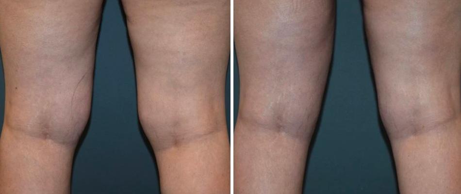 Thigh Liposuction - Sydney, Gold Coast, Canberra, Adelaide