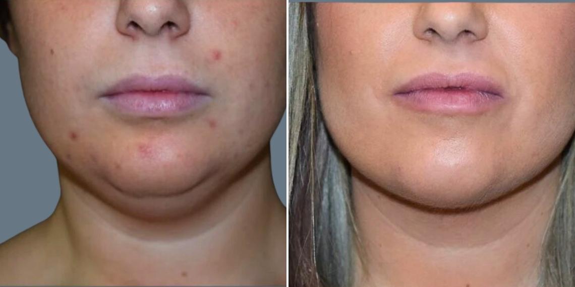 Before and After Chin Liposuction Results From Our Canberra Clinic ...