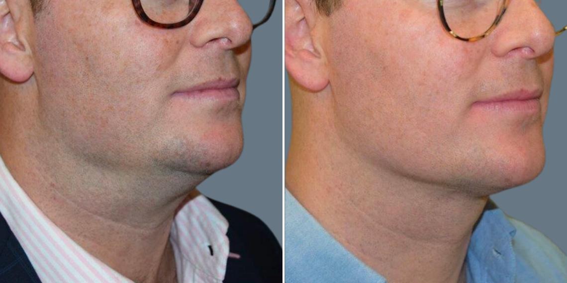 Before and After Chin Liposuction Results From Our Canberra Clinic - Levant Liposuction