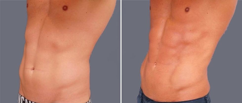 Vaser Hi-Def Liposuction - Sydney, Gold Coast, Canberra, Adelaide