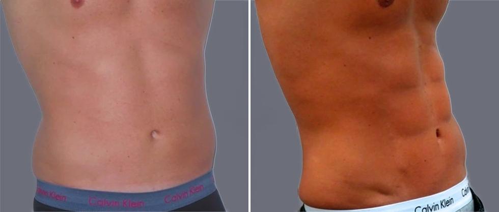 Vaser Hi-Def Liposuction - Sydney, Gold Coast, Canberra, Adelaide Vaser Hi-Def Liposuction - Sydney, Gold Coast, Canberra, Adelaide