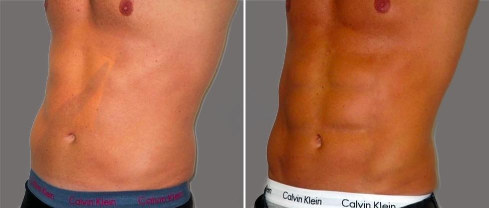 Vaser Hi-Def Liposuction - Sydney, Gold Coast, Canberra, Adelaide