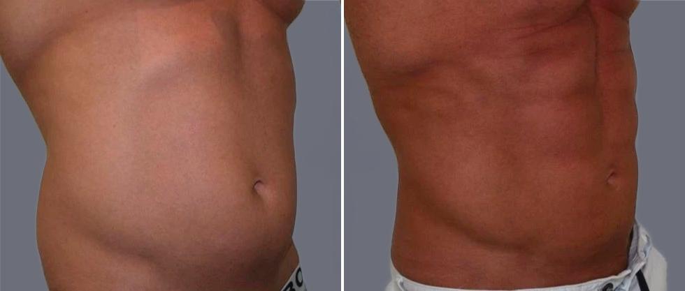 Vaser Hi-Def Liposuction - Sydney, Gold Coast, Canberra, Adelaide