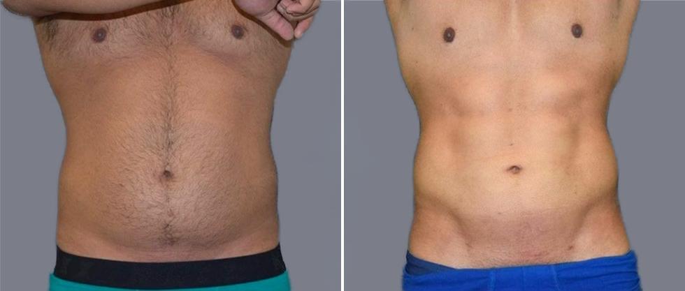 Vaser Hi-Def Liposuction - Sydney, Gold Coast, Canberra, Adelaide