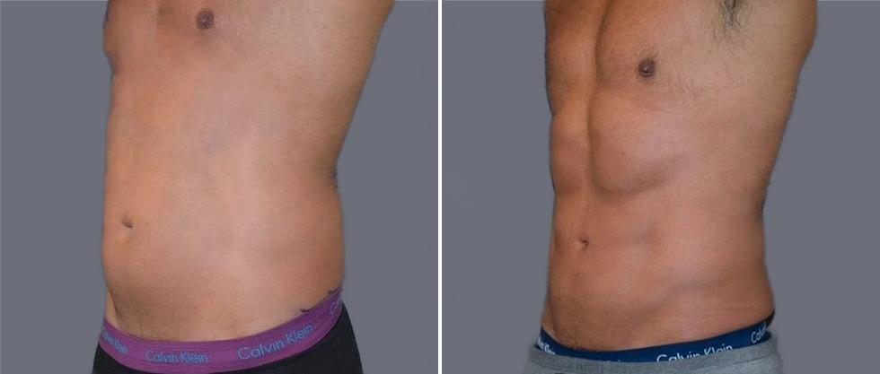 Vaser Hi-Def Liposuction - Sydney, Gold Coast, Canberra, Adelaide Vaser Hi-Def Liposuction - Sydney, Gold Coast, Canberra, Adelaide