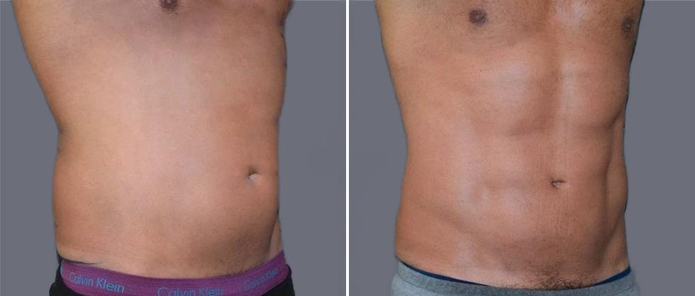 Vaser Hi-Def Liposuction - Sydney, Gold Coast, Canberra, Adelaide Vaser Hi-Def Liposuction - Sydney, Gold Coast, Canberra, Adelaide