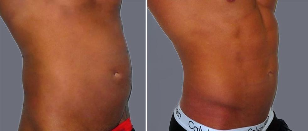 Vaser Hi-Def Liposuction - Sydney, Gold Coast, Canberra, Adelaide Vaser Hi-Def Liposuction - Sydney, Gold Coast, Canberra, Adelaide