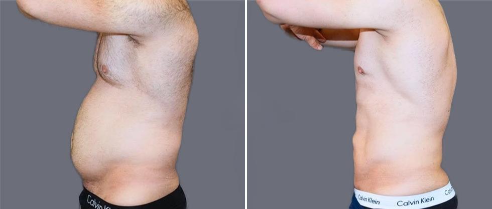 Vaser Hi-Def Liposuction - Sydney, Gold Coast, Canberra, Adelaide