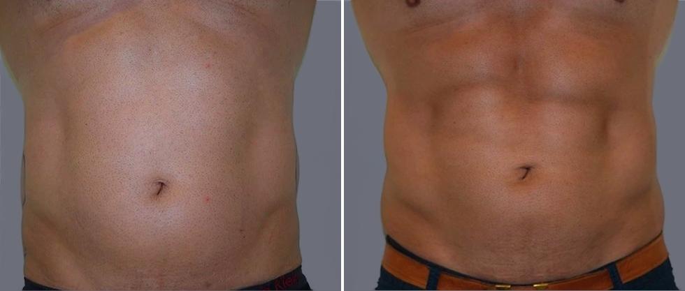 Vaser Hi-Def Liposuction - Sydney, Gold Coast, Canberra, Adelaide