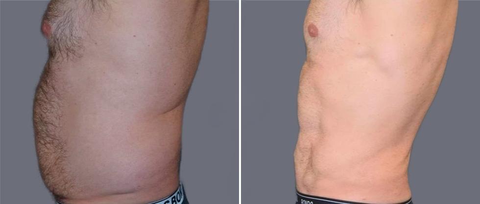 Vaser Hi-Def Liposuction - Sydney, Gold Coast, Canberra, Adelaide