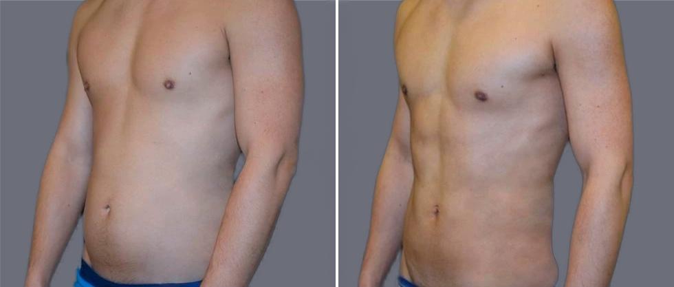 Vaser Hi-Def Liposuction - Sydney, Gold Coast, Canberra, Adelaide Vaser Hi-Def Liposuction - Sydney, Gold Coast, Canberra, Adelaide
