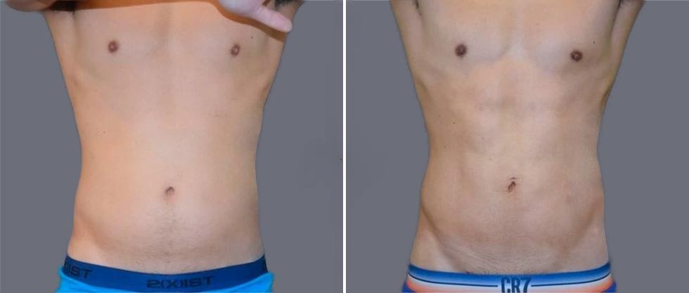 Vaser Hi-Def Liposuction - Sydney, Gold Coast, Canberra, Adelaide