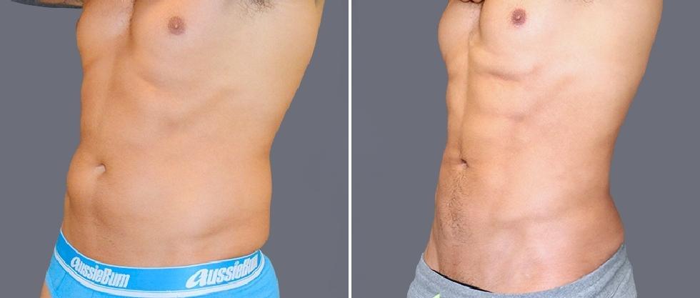 Vaser Hi-Def Liposuction - Sydney, Gold Coast, Canberra, Adelaide