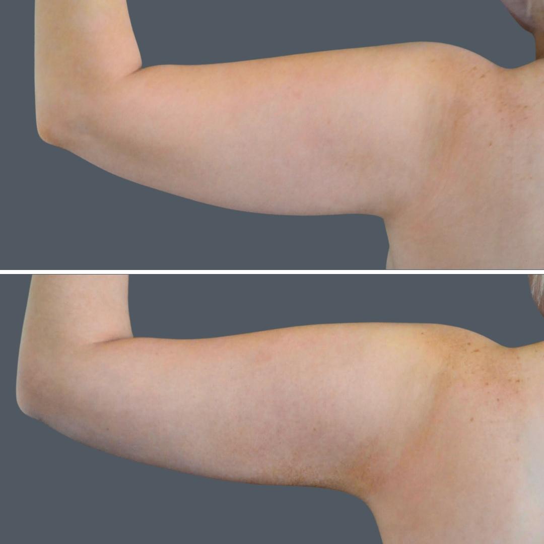 Arm Liposuction - Sydney, Gold Coast, Canberra, Adelaide