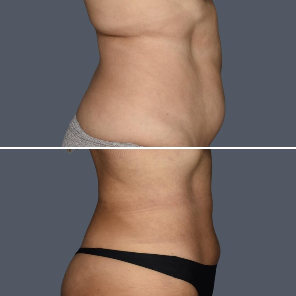 Managing Weight Gain After Liposuction Treatment - Levant Liposuction