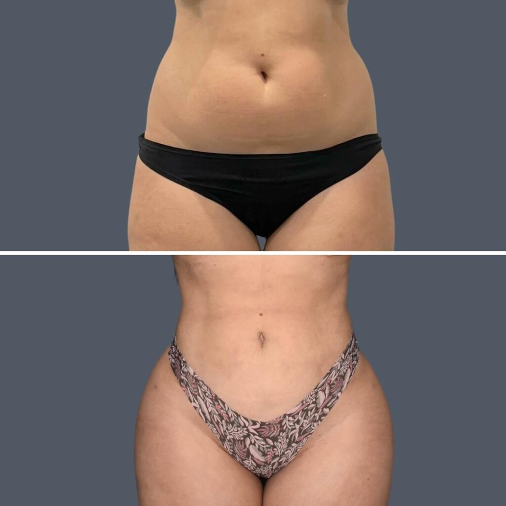 Managing Weight Gain After Liposuction Treatment - Levant Liposuction