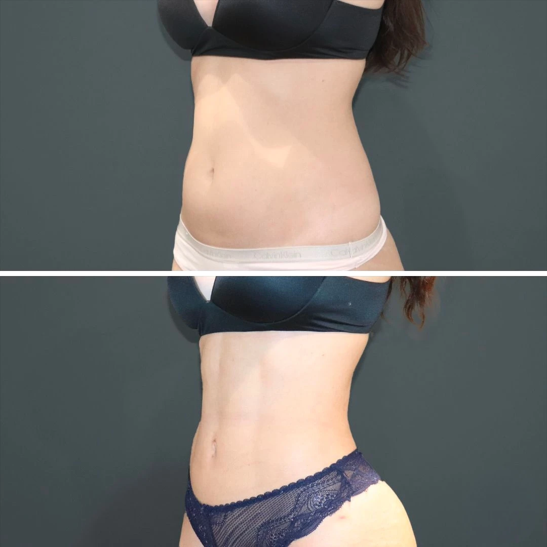 Vaser Liposuction - Sydney, Gold Coast, Canberra, Adelaide