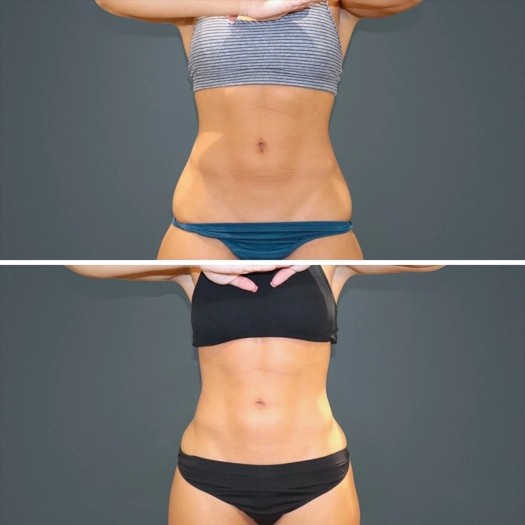 Vaser Hi-Def Liposuction - Sydney, Gold Coast, Canberra, Adelaide Vaser Hi-Def Liposuction - Sydney, Gold Coast, Canberra, Adelaide