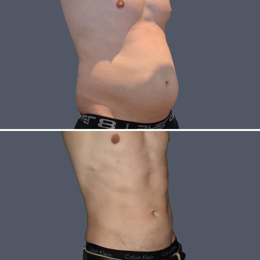 Vaser Hi-Def Liposuction - Sydney, Gold Coast, Canberra, Adelaide Vaser Hi-Def Liposuction - Sydney, Gold Coast, Canberra, Adelaide