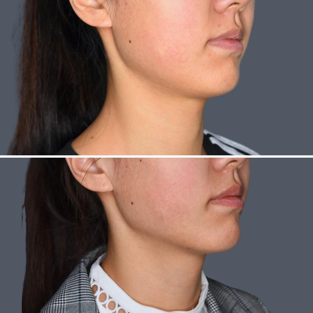 Abdominal Liposuction - Sydney, Gold Coast, Canberra, Adelaide