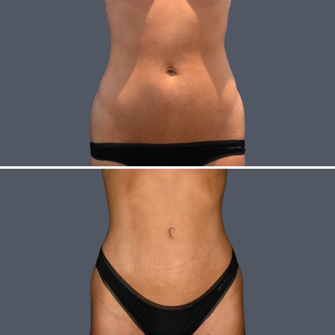 Abdominal Liposuction - Sydney, Gold Coast, Canberra, Adelaide