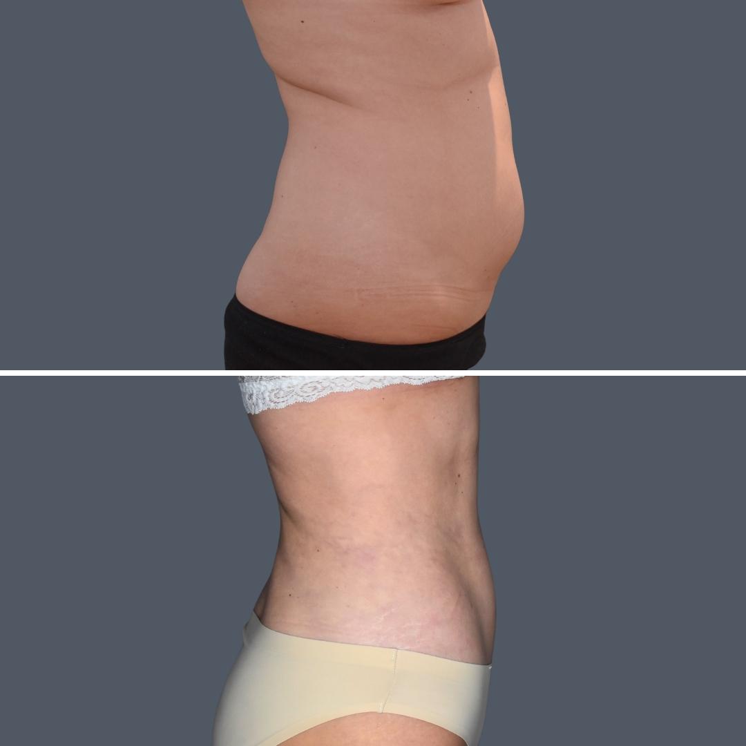 Abdominal Liposuction - Sydney, Gold Coast, Canberra, Adelaide