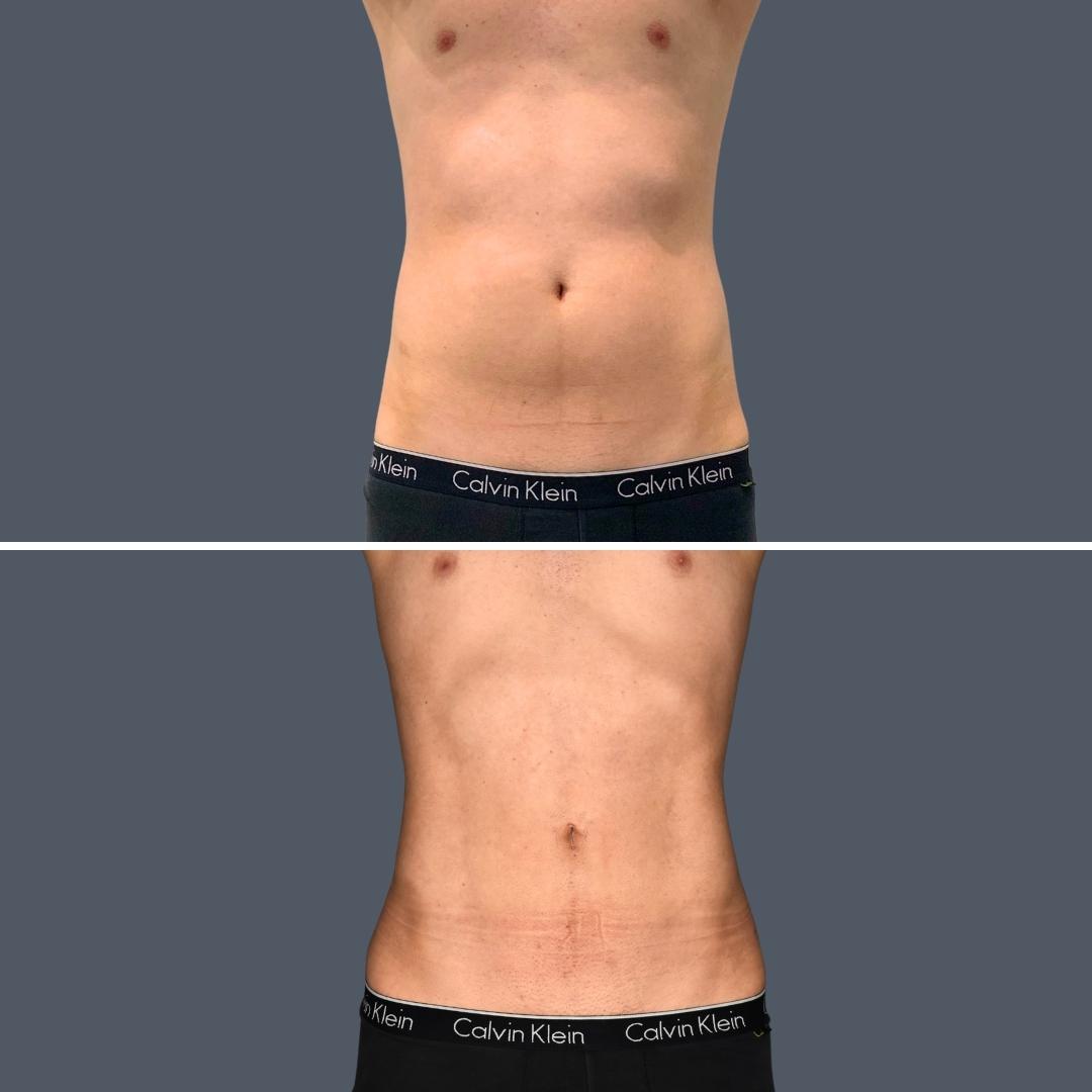 Gallery - Levant Liposuction
