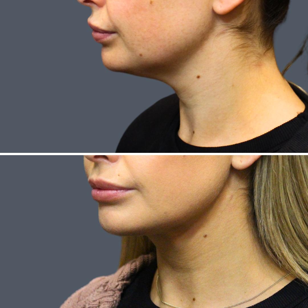 Vaser Liposuction - Sydney, Gold Coast, Canberra, Adelaide