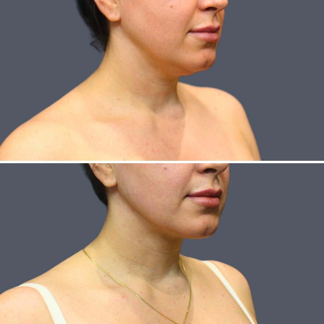 Vaser Liposuction - Sydney, Gold Coast, Canberra, Adelaide
