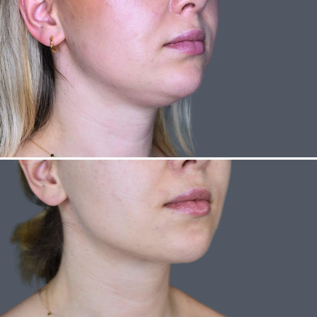 Vaser Liposuction - Sydney, Gold Coast, Canberra, Adelaide