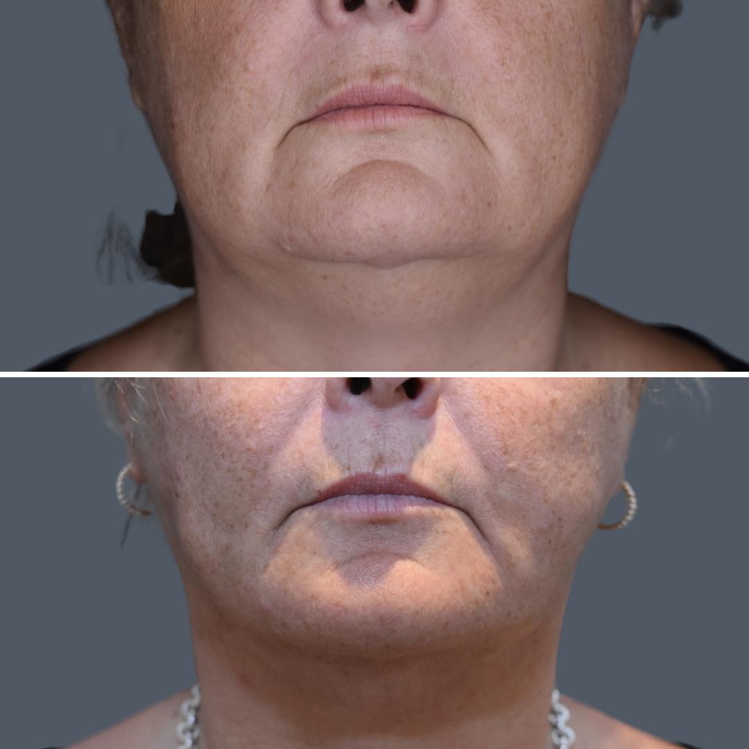 Vaser Liposuction - Sydney, Gold Coast, Canberra, Adelaide