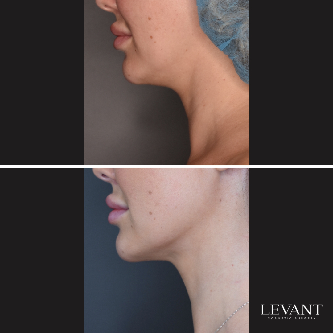 Chin/Neck Liposuction - Sydney, Gold Coast, Canberra, Adelaide